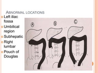 GROSS ANATOMY OF CAECUM & APPENDIX DR VKVS MBBS, MD.ppt