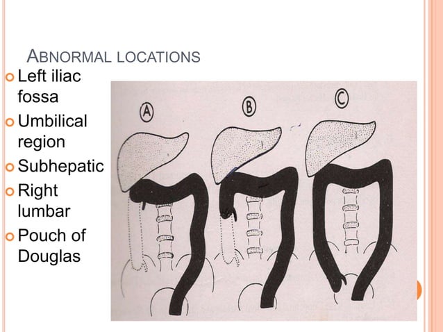 GROSS ANATOMY OF CAECUM & APPENDIX DR VKVS.ppt