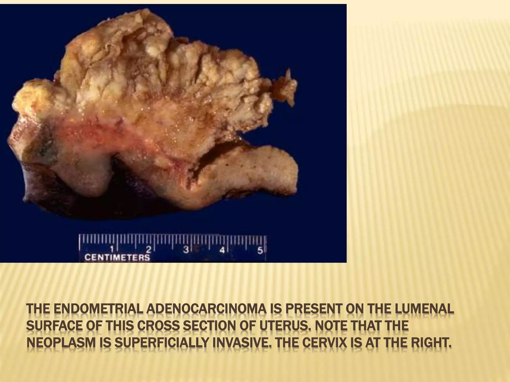 Ca endometrium | PPTX