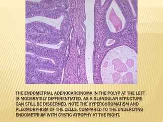 Ca endometrium | PPT