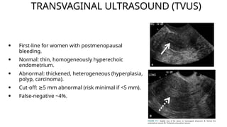 CA ENDOMETRIUM.pptx CA ENDOMETRIUM PPT CA | PPTX