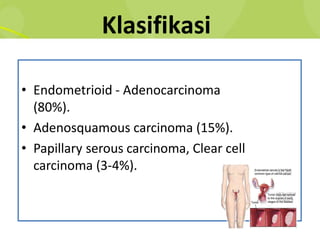 Ca Endometrium ROB.pptx