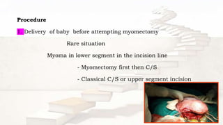 caesarean myomectomy ppt.pptx