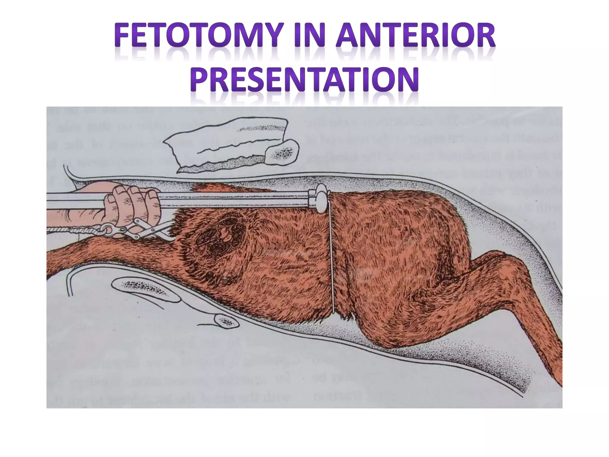 caesarean operation.pptx