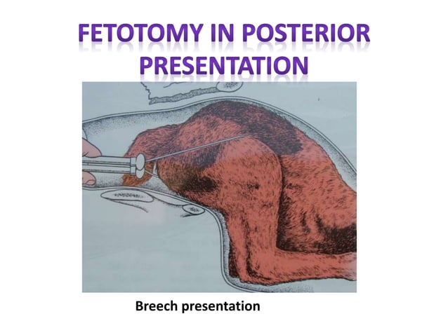 caesarean operation.pptx