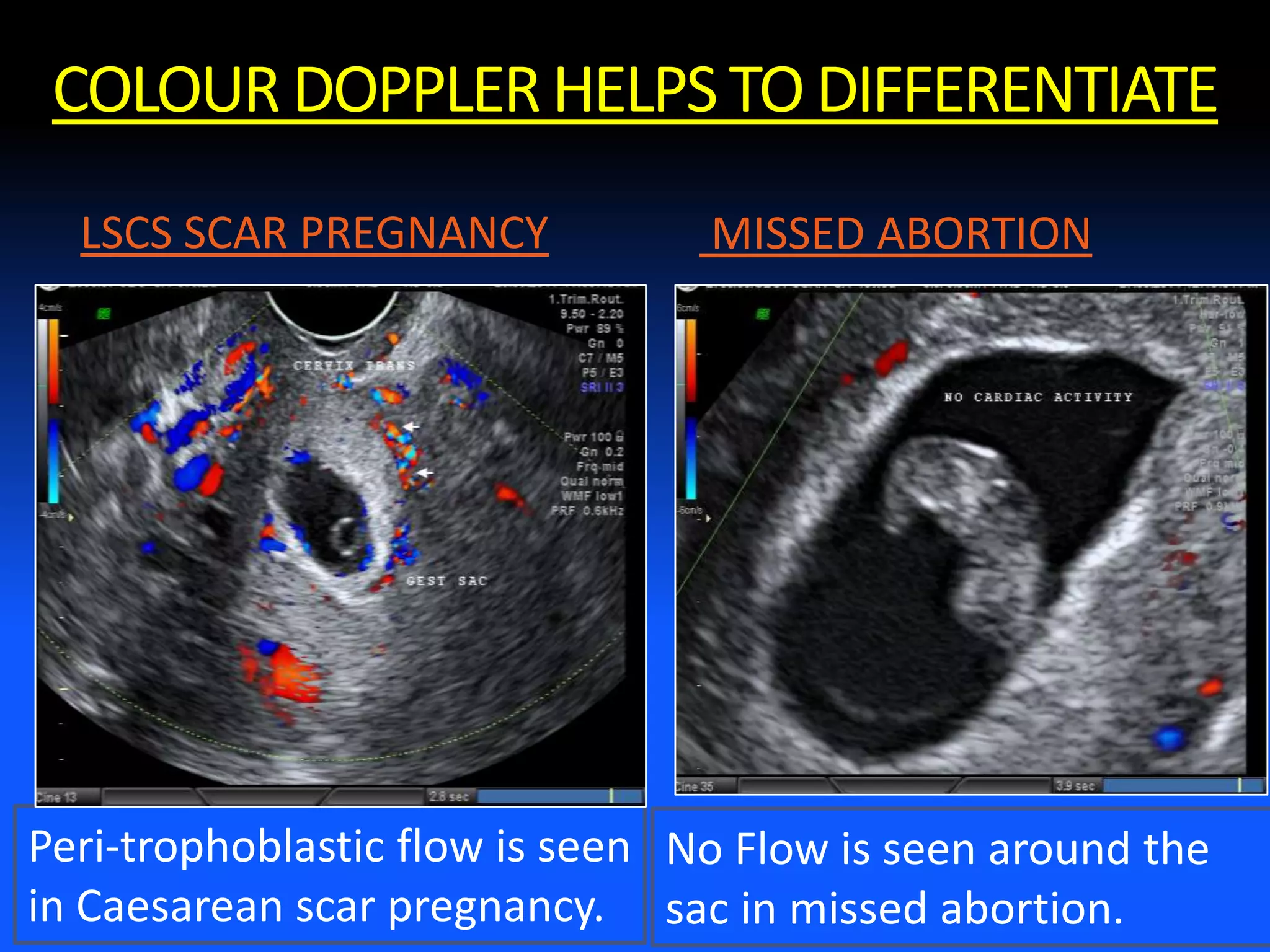Caesarean scar pregnancy.ppt