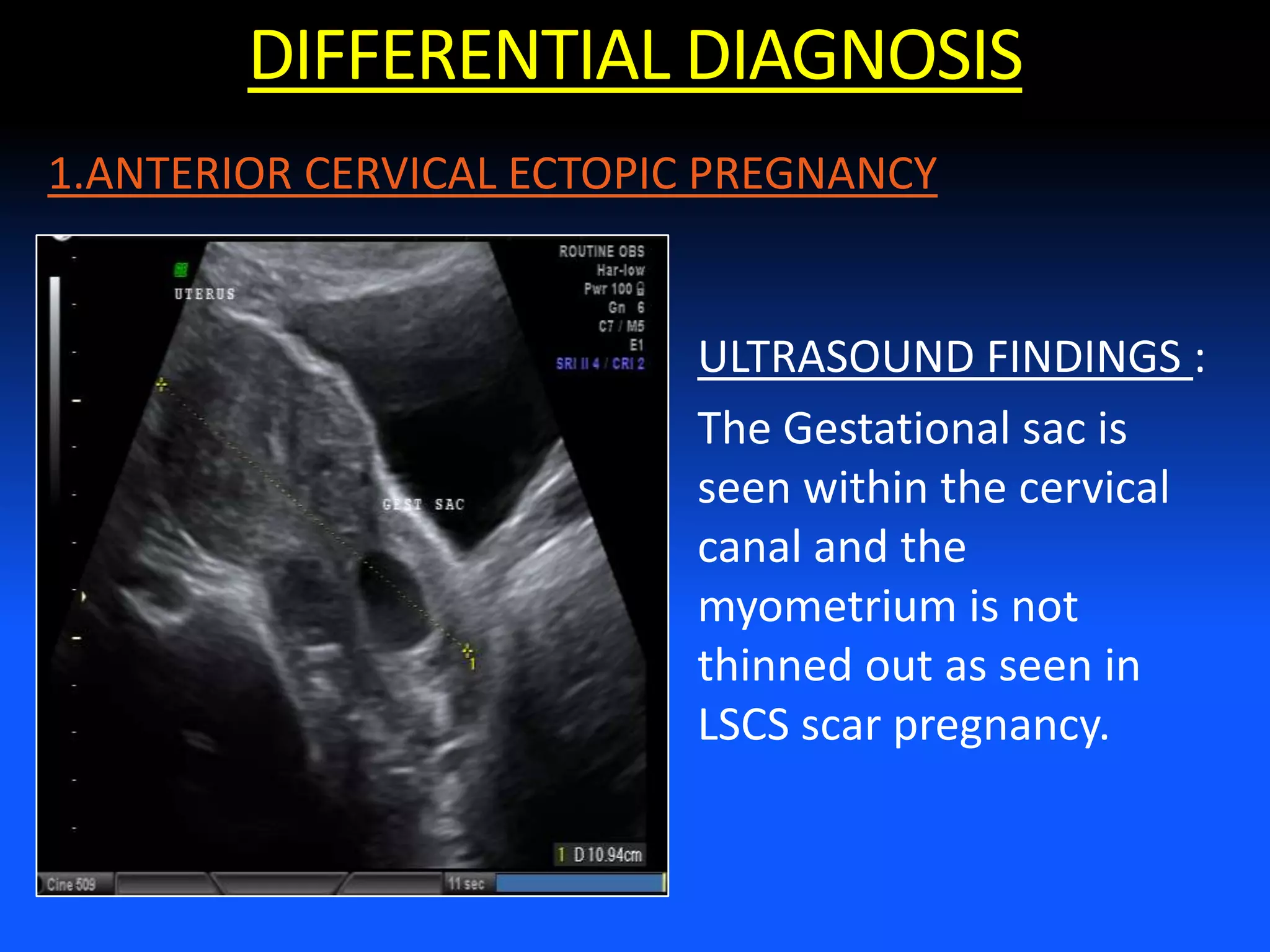 Caesarean scar pregnancy.ppt