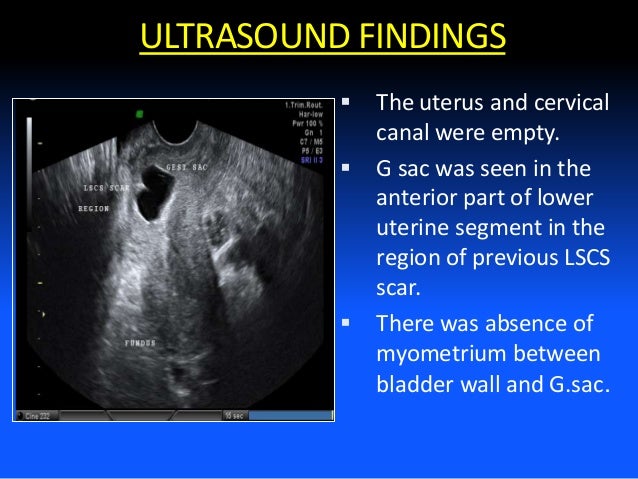 Uterus Scar Tissue After Abortion