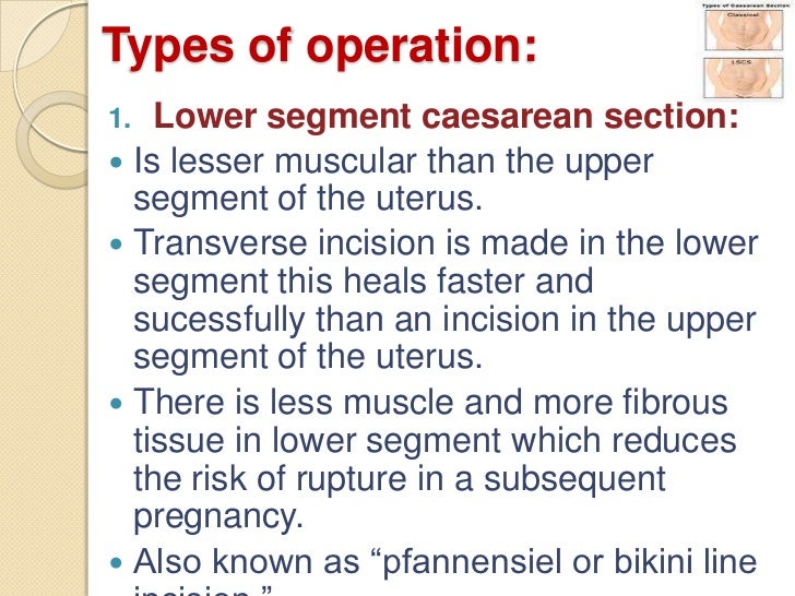 Caesarean section