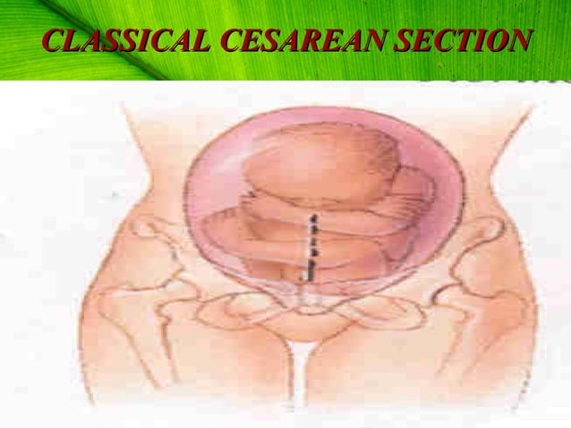 Caesarean section | PPT