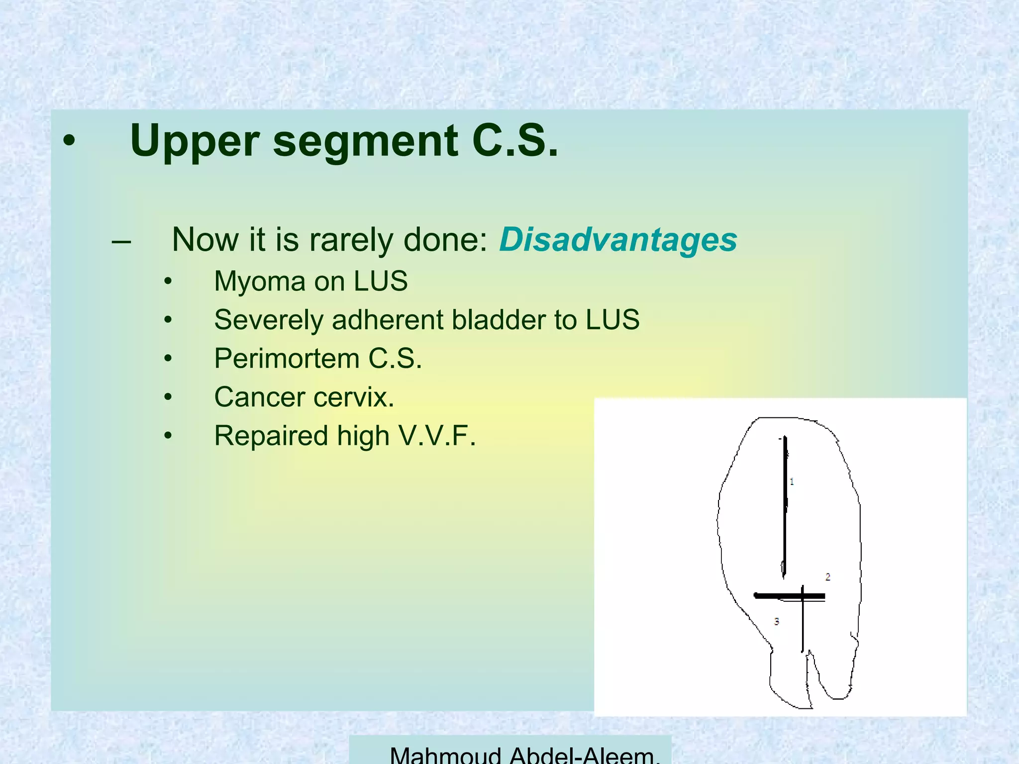 Caesarean section | PPT