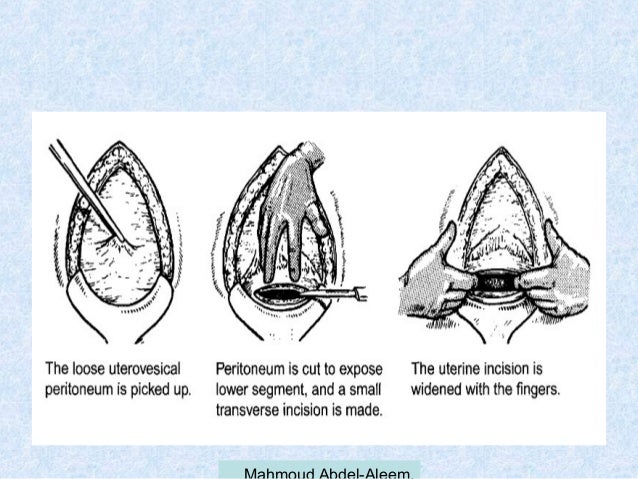 Caesarean section