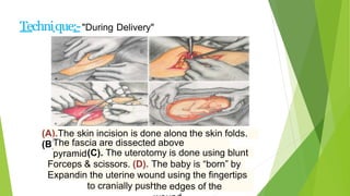 Caesarean section | PPTX