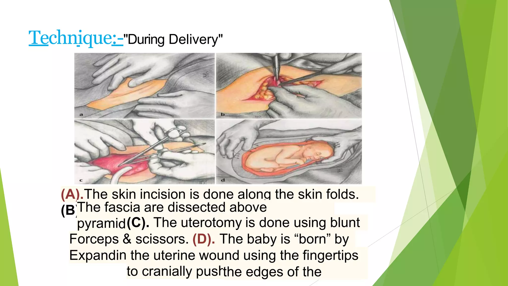 caesareansection-200511114205 (1).pptx