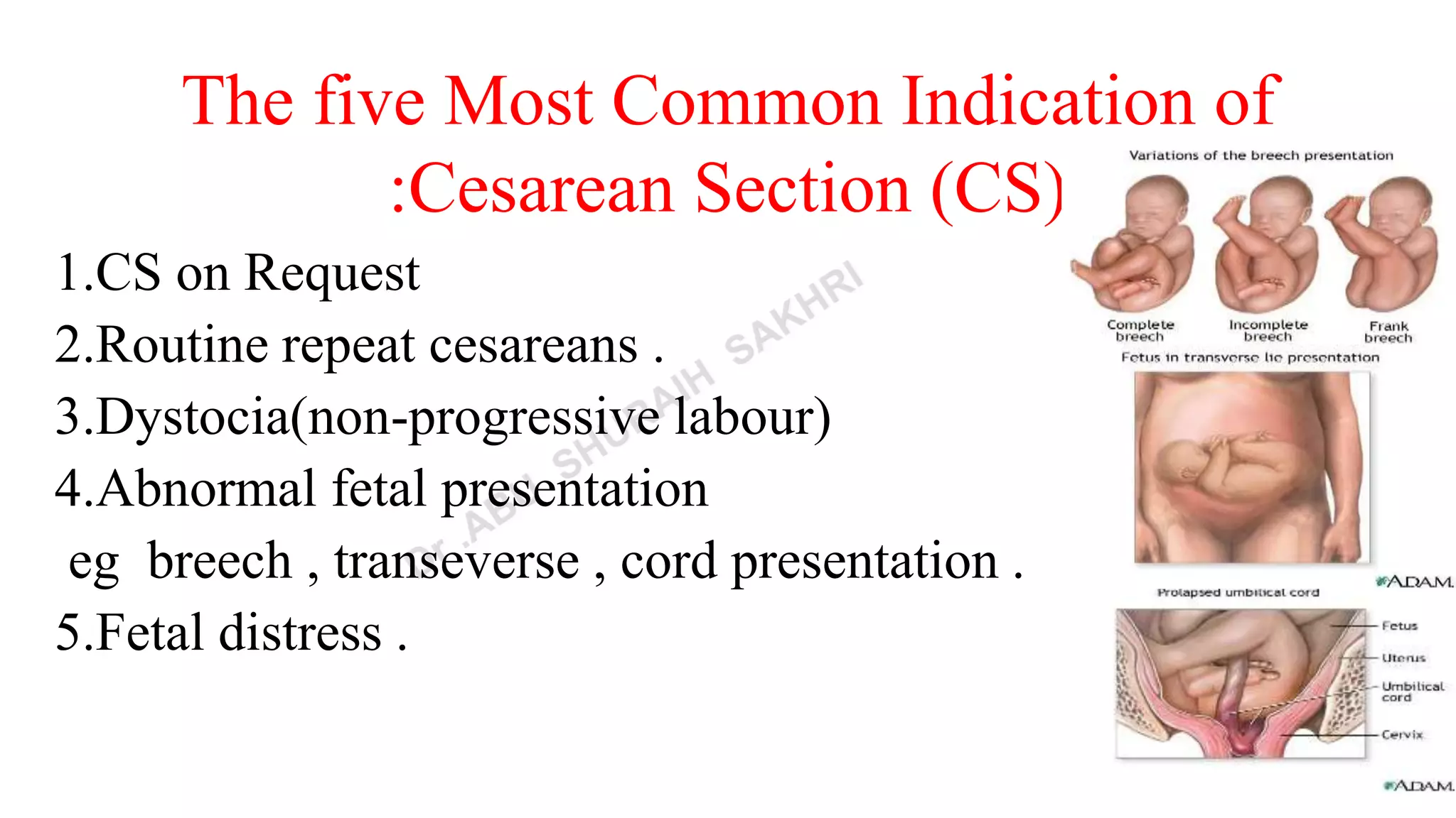 Caesarean section | PPTX