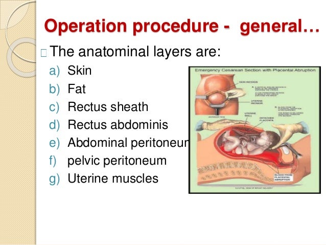Caesareansection best