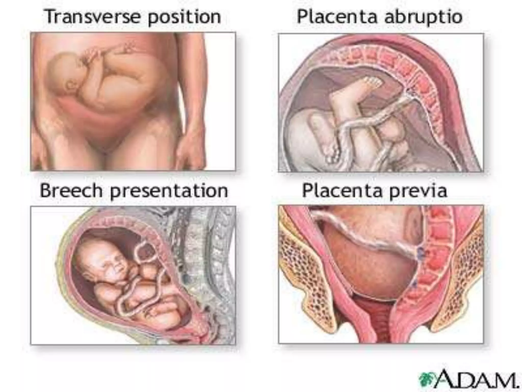 Caesarean Section Indications And Types Pptx