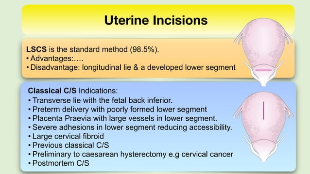 Caesarean Section (C/S).pdf