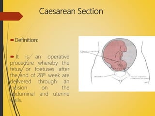 Cesarean Section Technique With Diagram