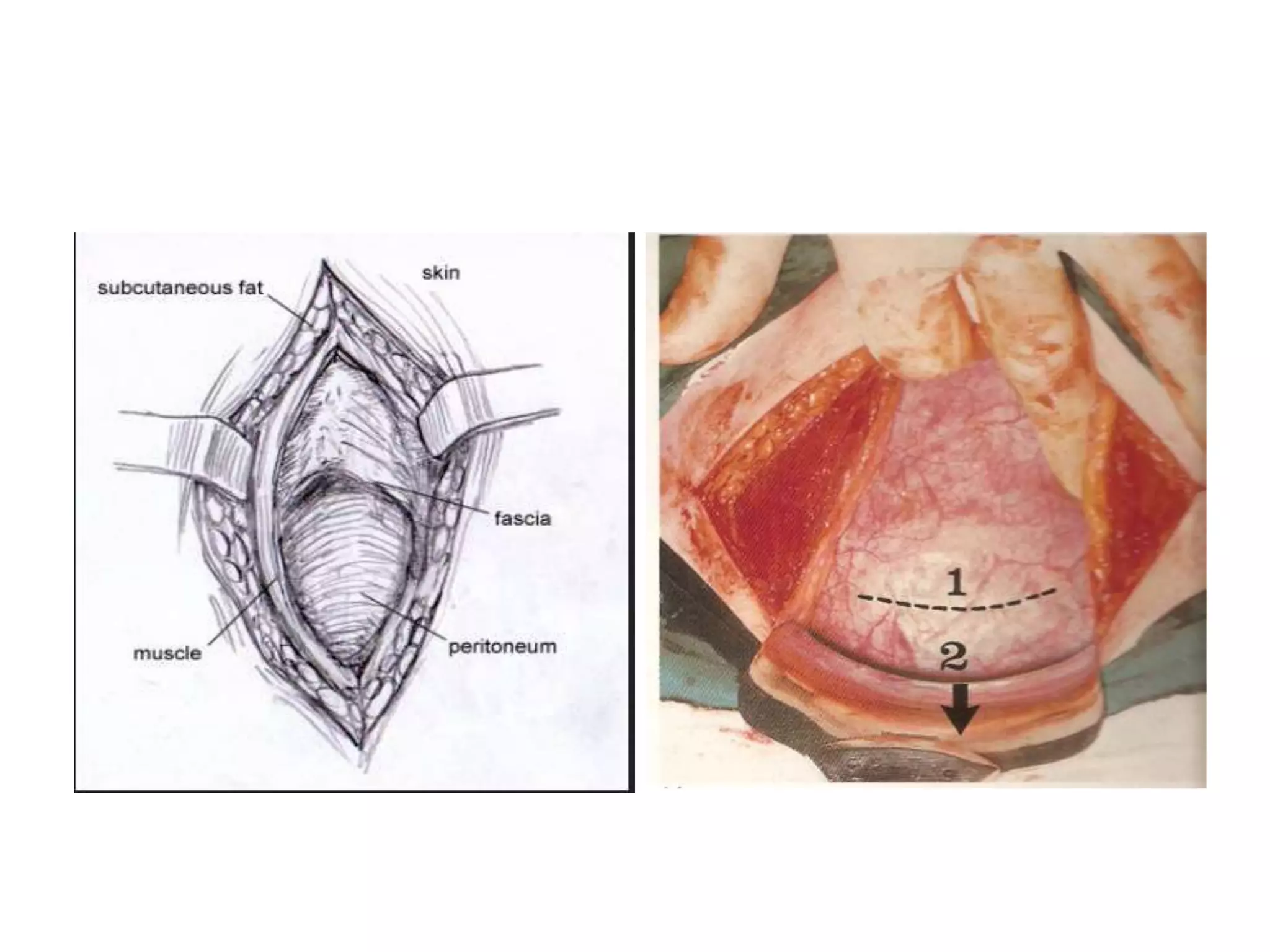 Caesarean section (techniques) pgp | PPTX
