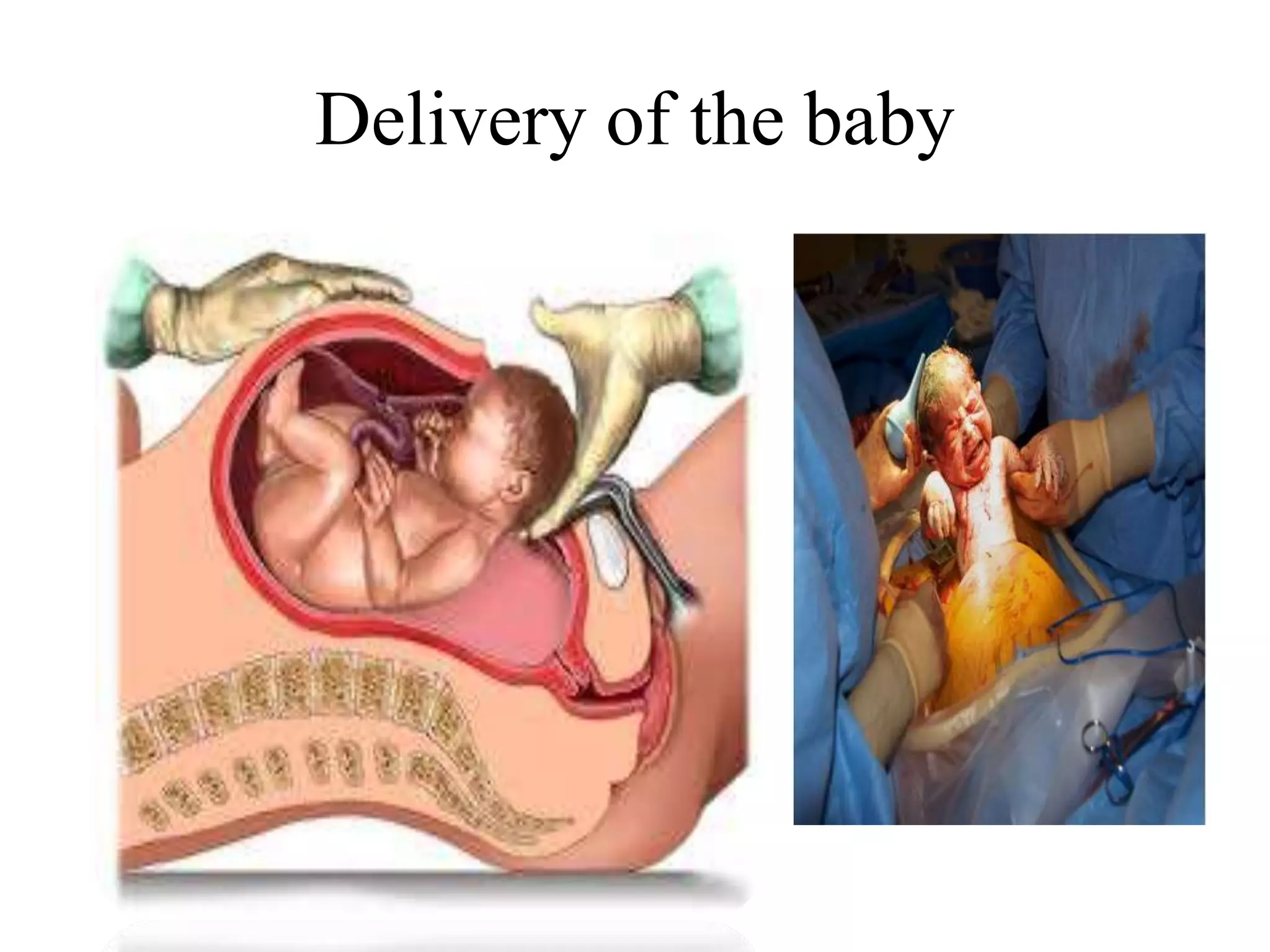 Caesarean section (techniques) pgp | PPTX