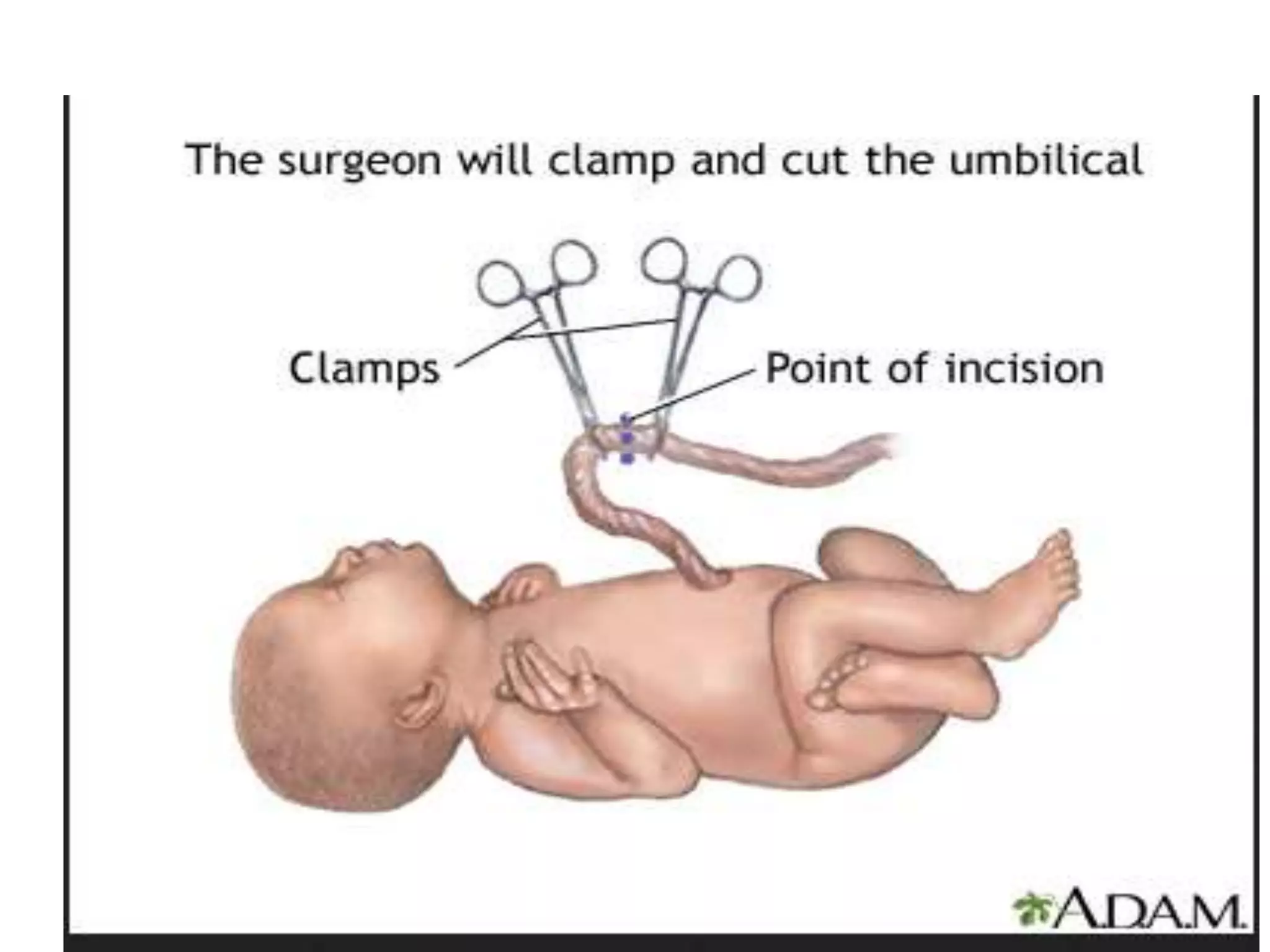 Caesarean section (techniques) pgp | PPTX