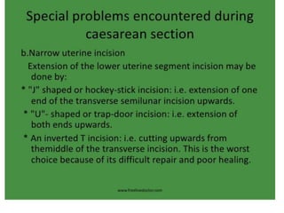 Caesarian section | PPT