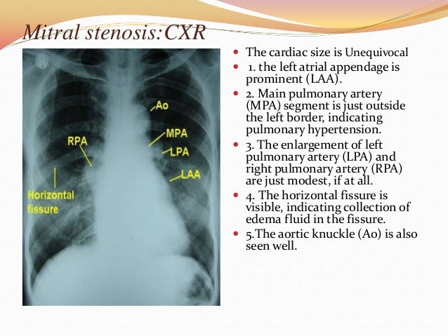 Caeserean section complicated by mitral stenosis