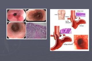 CANCER DE ESOFAGO | PPTX