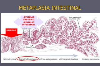 CANCER DE ESOFAGO | PPTX