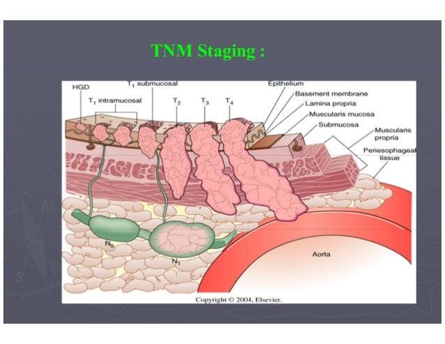 Carcinoma esophagus