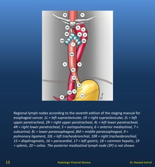 Carcinoma of Esophagus | PDF