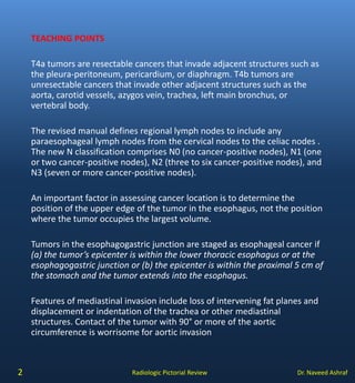 Carcinoma of Esophagus | PDF