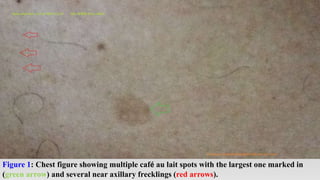 Café Au Lait Spot is A Marker for Pheochromocytoma in Hypertensive ...