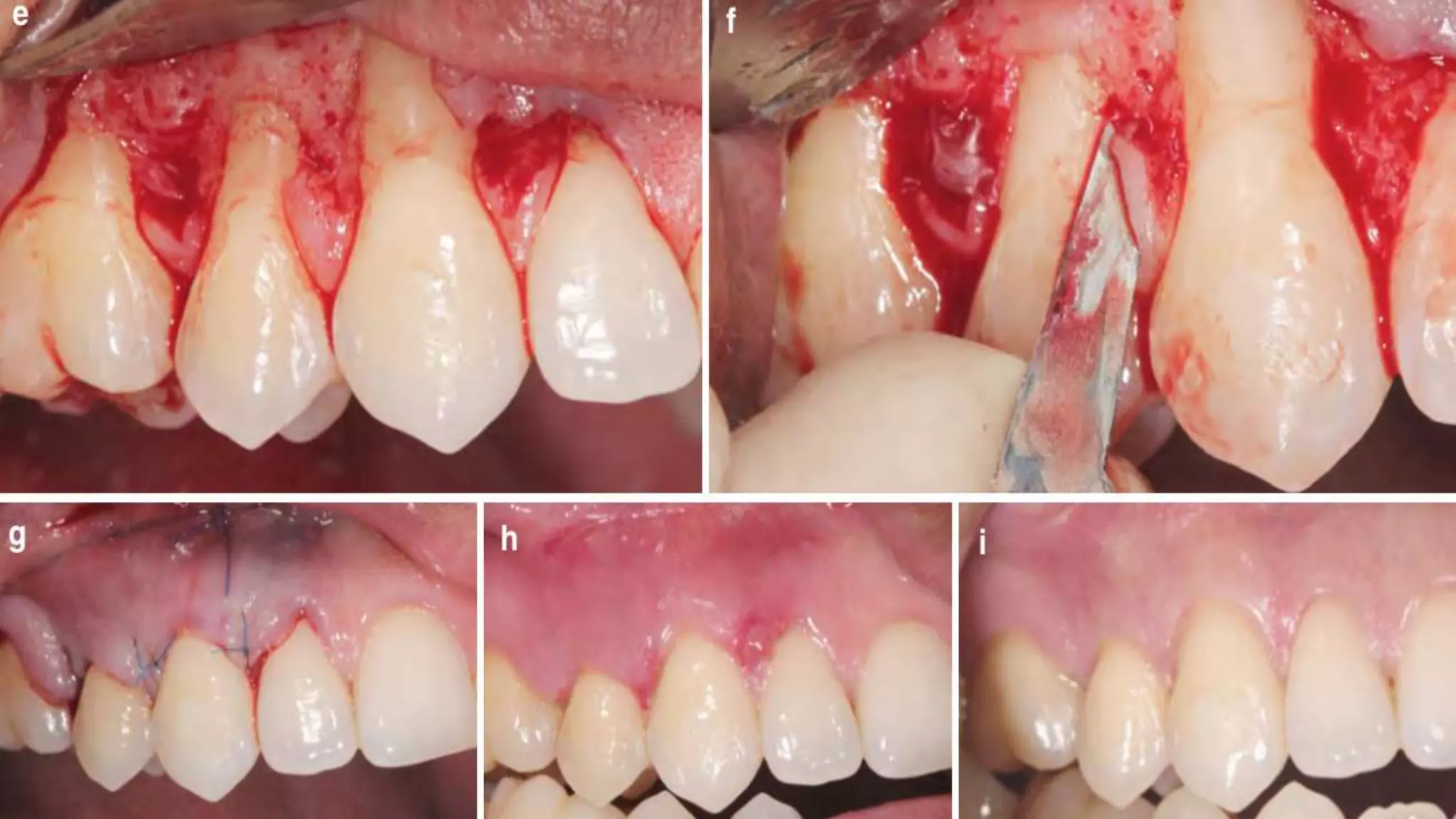 Laterally Positioned Flap VS Coronally Advanced Flap | PPTX