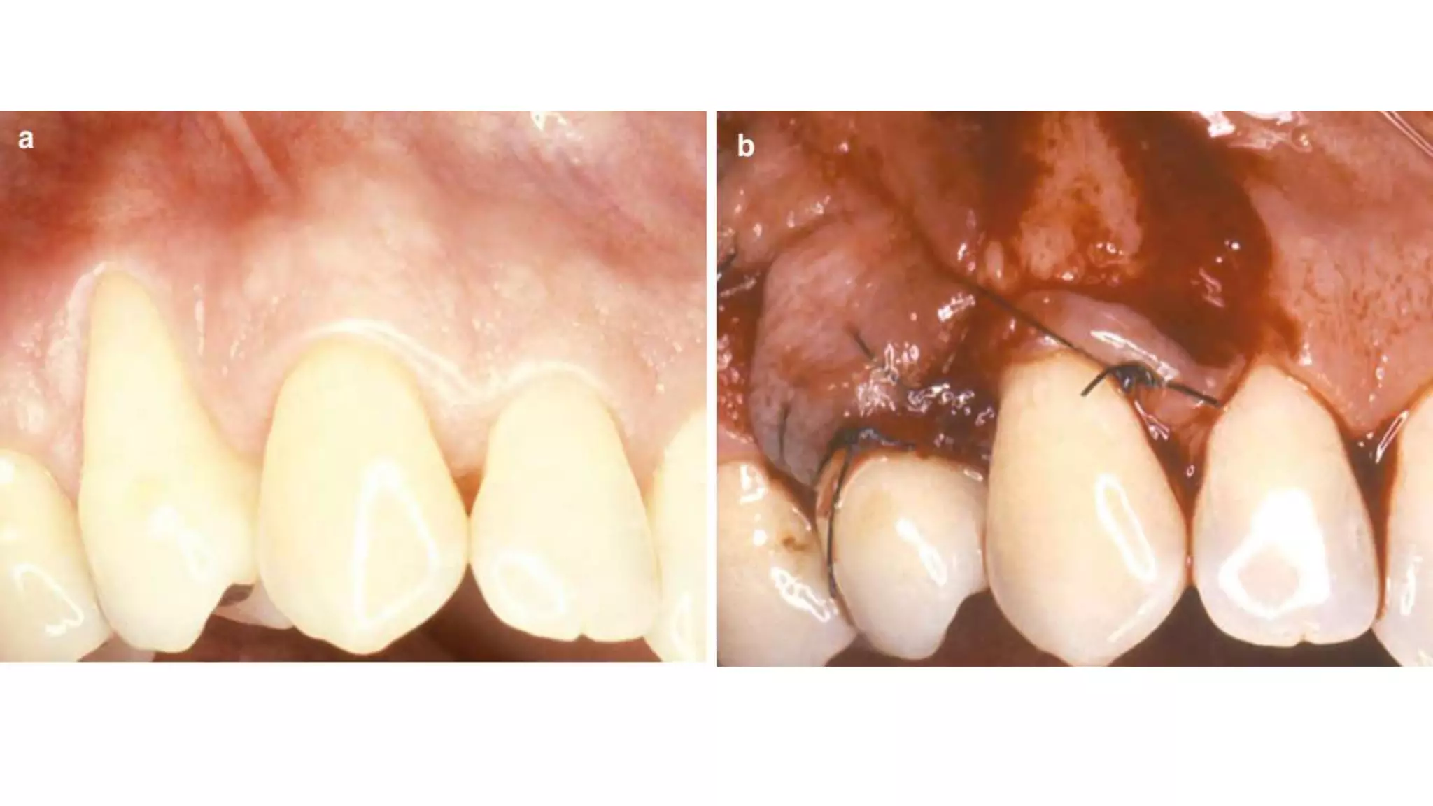 Laterally Positioned Flap VS Coronally Advanced Flap | PPTX