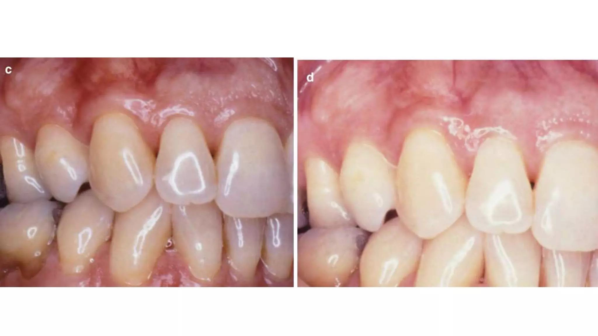 Laterally Positioned Flap VS Coronally Advanced Flap | PPTX