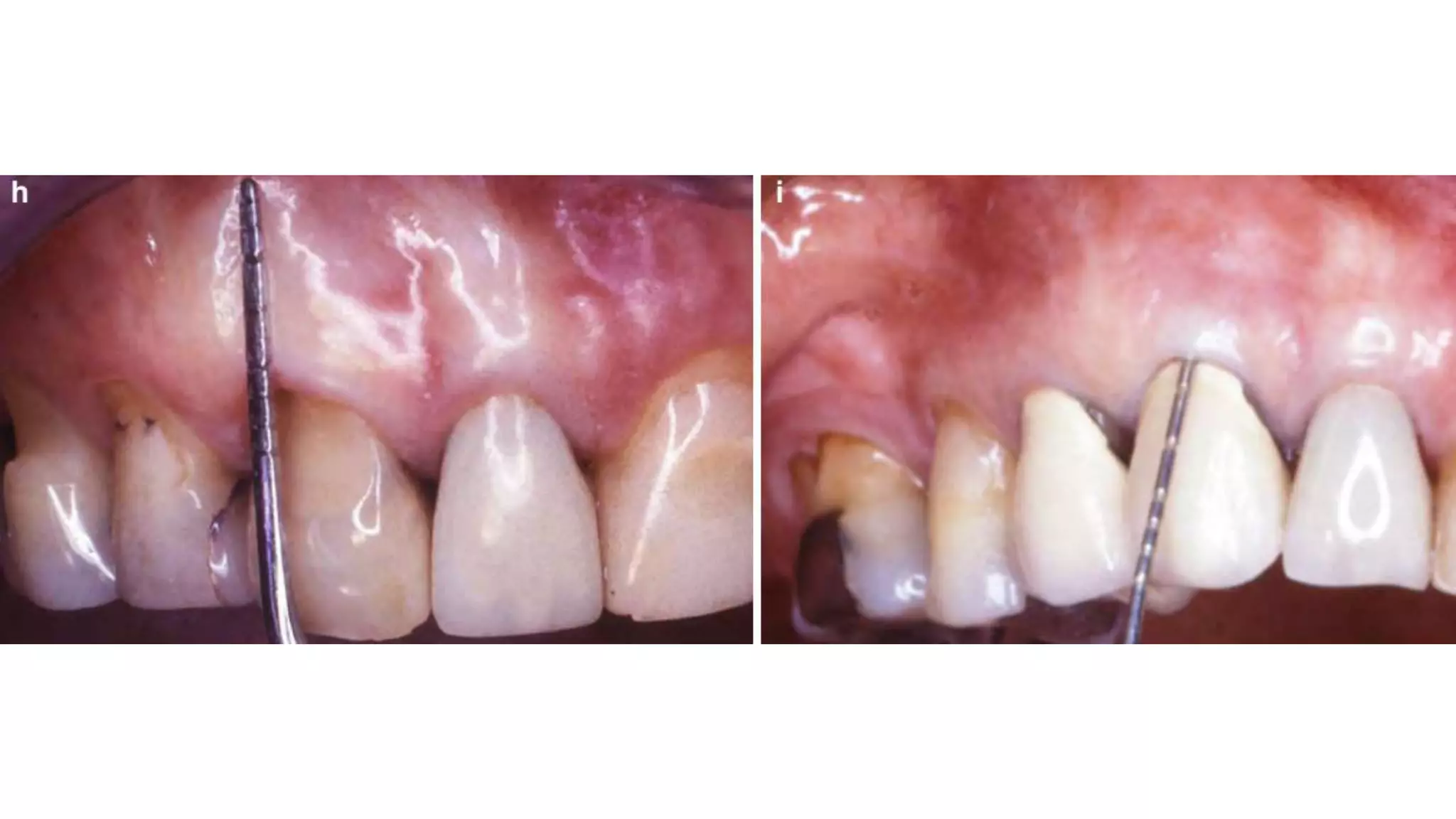Laterally Positioned Flap VS Coronally Advanced Flap | PPTX