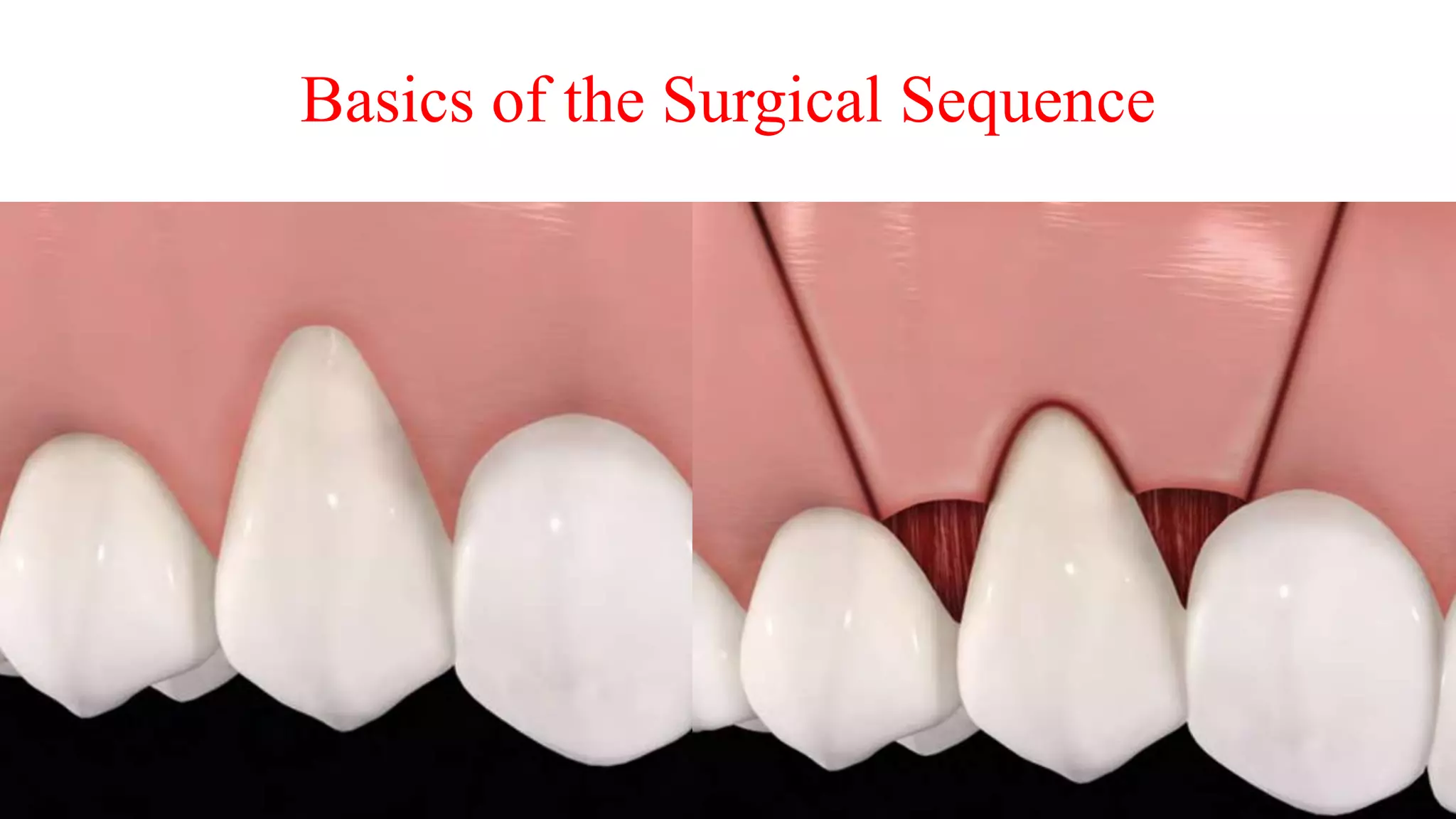 Laterally Positioned Flap VS Coronally Advanced Flap | PPTX