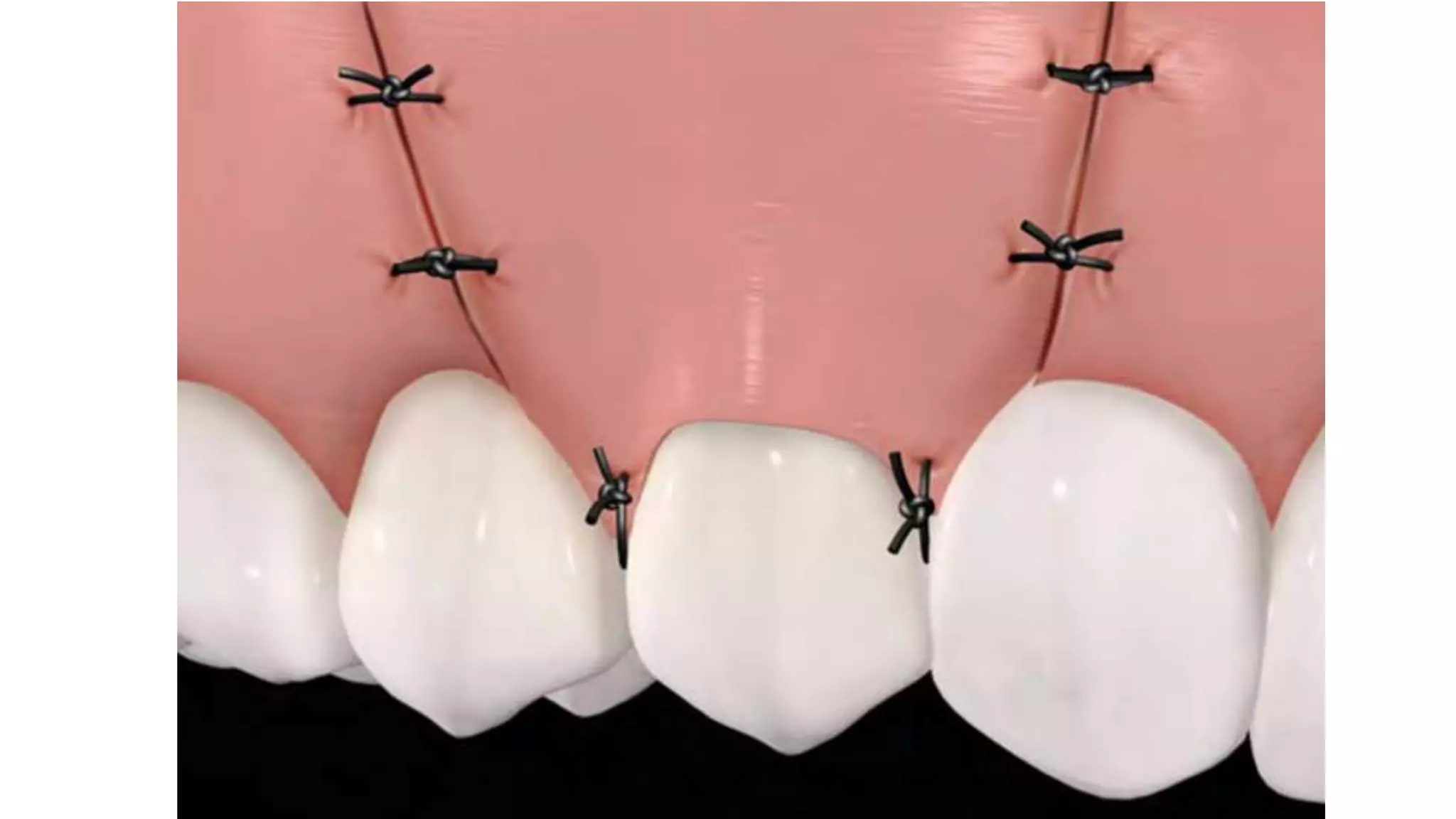 Laterally Positioned Flap VS Coronally Advanced Flap | PPTX