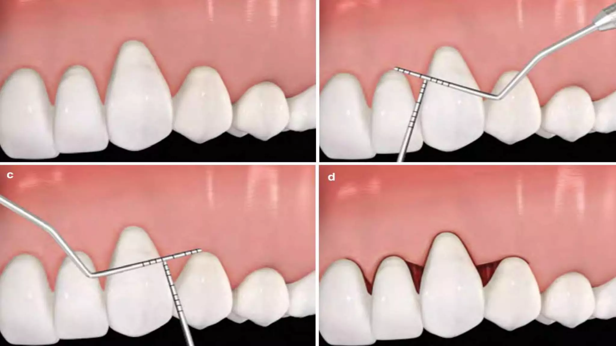 Laterally Positioned Flap VS Coronally Advanced Flap | PPTX