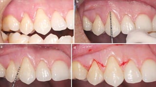 Laterally Positioned Flap VS Coronally Advanced Flap | PPTX | Dental ...