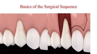 Laterally Positioned Flap VS Coronally Advanced Flap | PPTX | Dental ...
