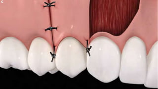 Laterally Positioned Flap VS Coronally Advanced Flap | PPTX | Dental ...