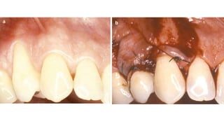 Laterally Positioned Flap VS Coronally Advanced Flap | PPTX | Dental ...