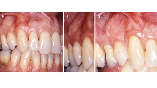 Laterally Positioned Flap VS Coronally Advanced Flap | PPTX | Dental ...