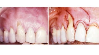 Laterally Positioned Flap VS Coronally Advanced Flap | PPTX | Dental ...