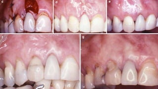 Laterally Positioned Flap VS Coronally Advanced Flap | PPTX | Dental ...