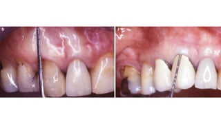 Laterally Positioned Flap VS Coronally Advanced Flap | PPTX | Dental ...