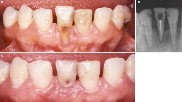 Laterally Positioned Flap VS Coronally Advanced Flap | PPTX | Dental ...